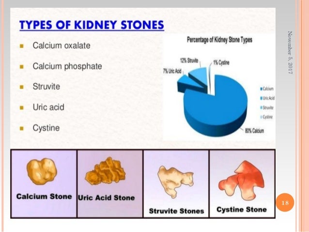 Renal calculi
