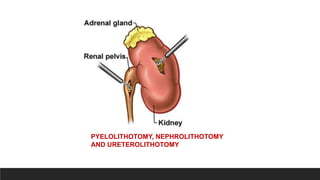renal calculi power point presentation c | PPTX