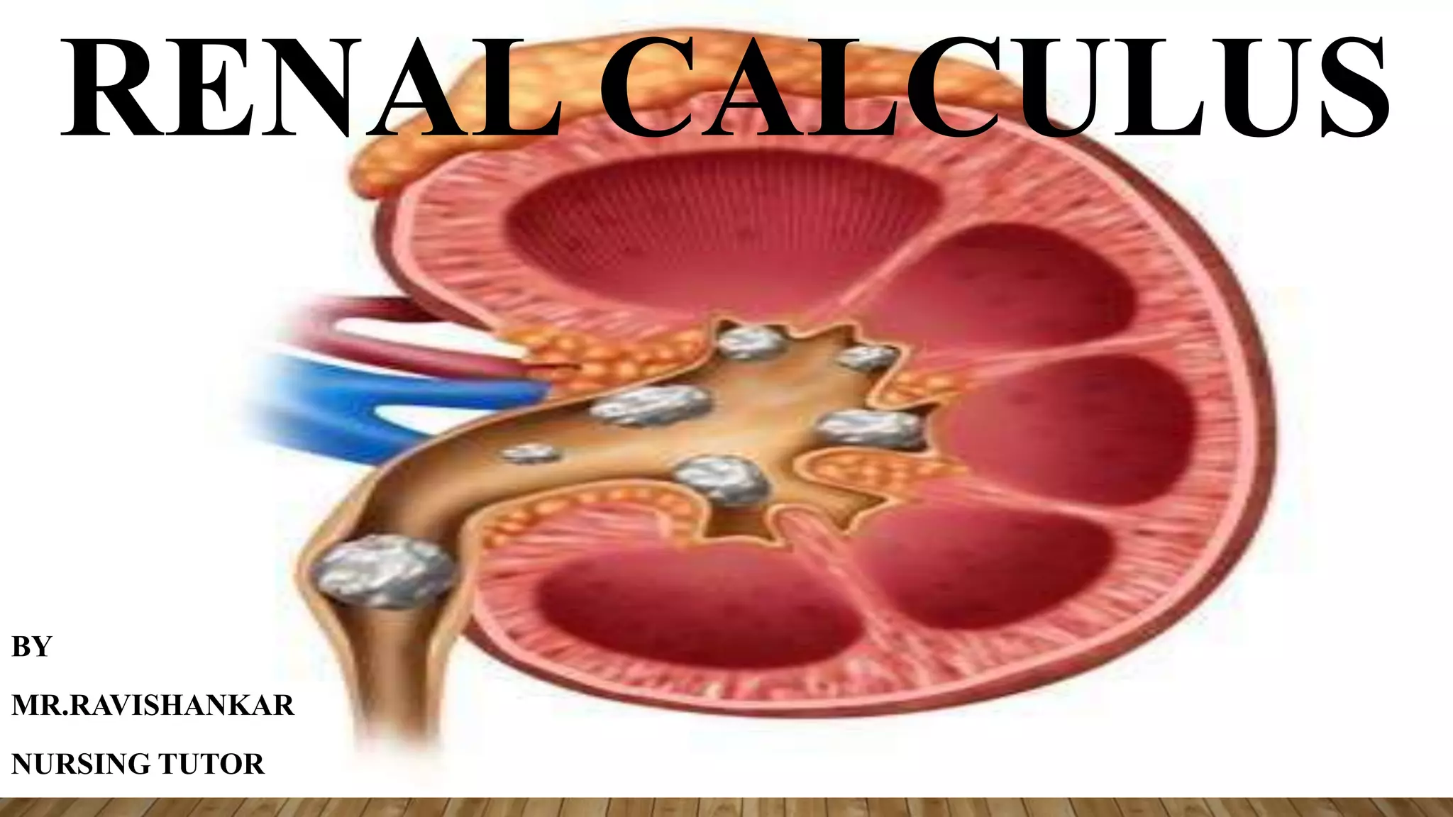 Renal calculus.pptx