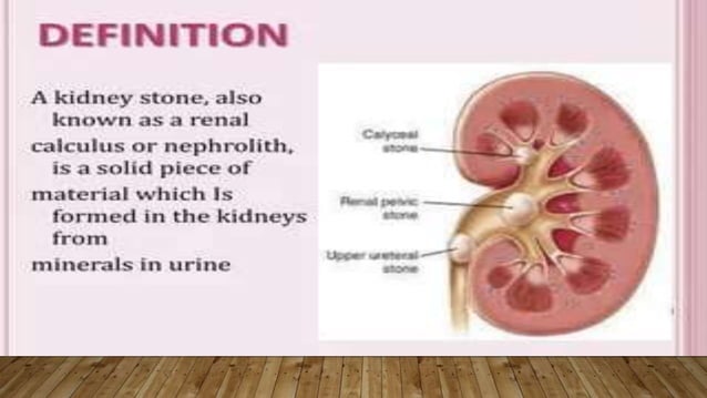 Renal calculus.pptx
