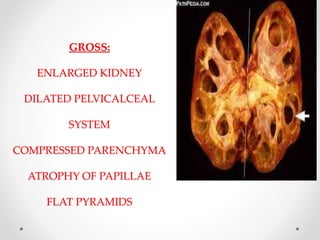 RENAL CALICULI.pptx