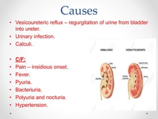 RENAL CALICULI.pptx