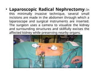 RENAL CELL CANCER for adult health nursing.pptx