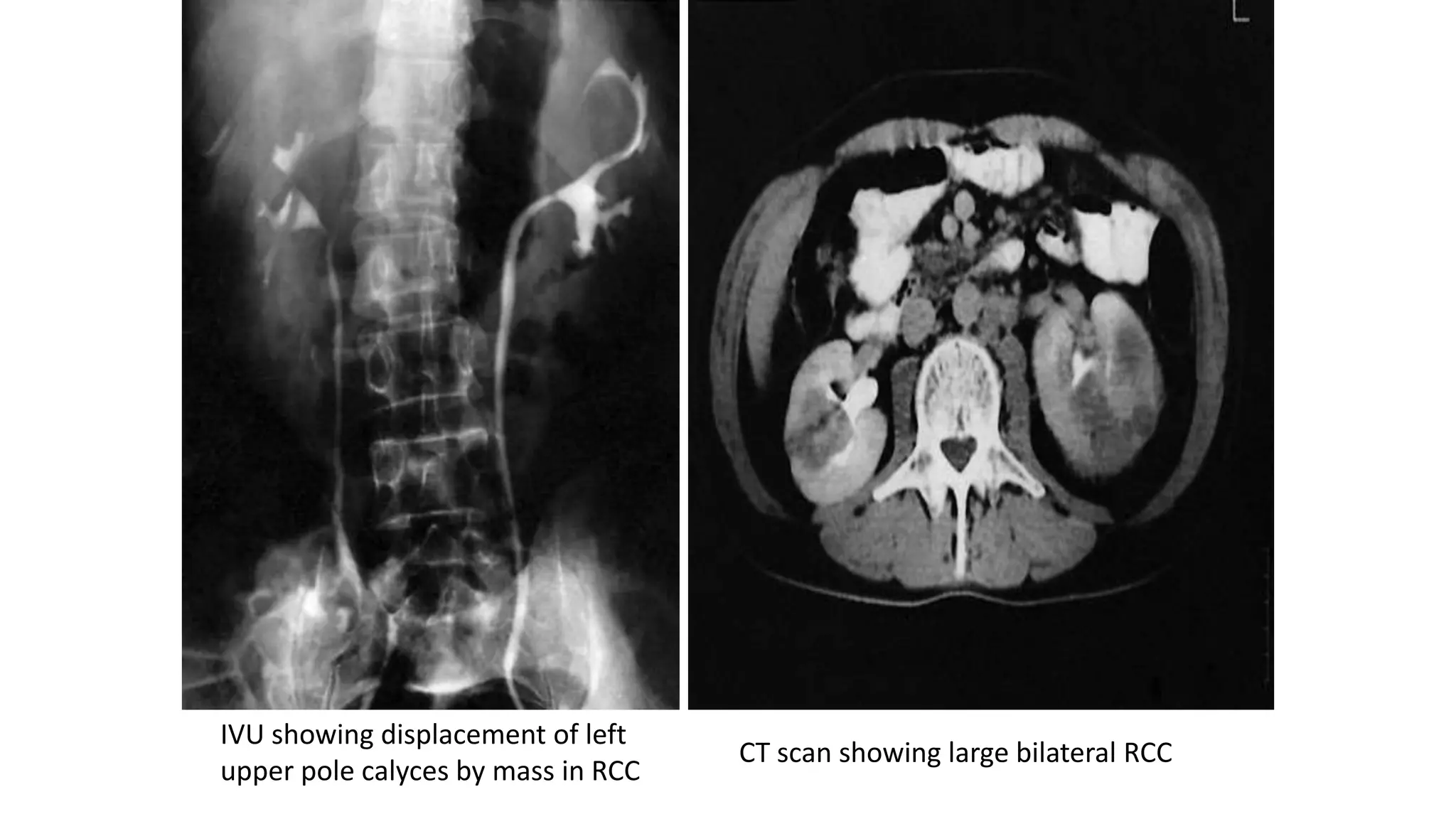 Tumors of kidney and Bladder by Sunil Kumar Daha | PPTX