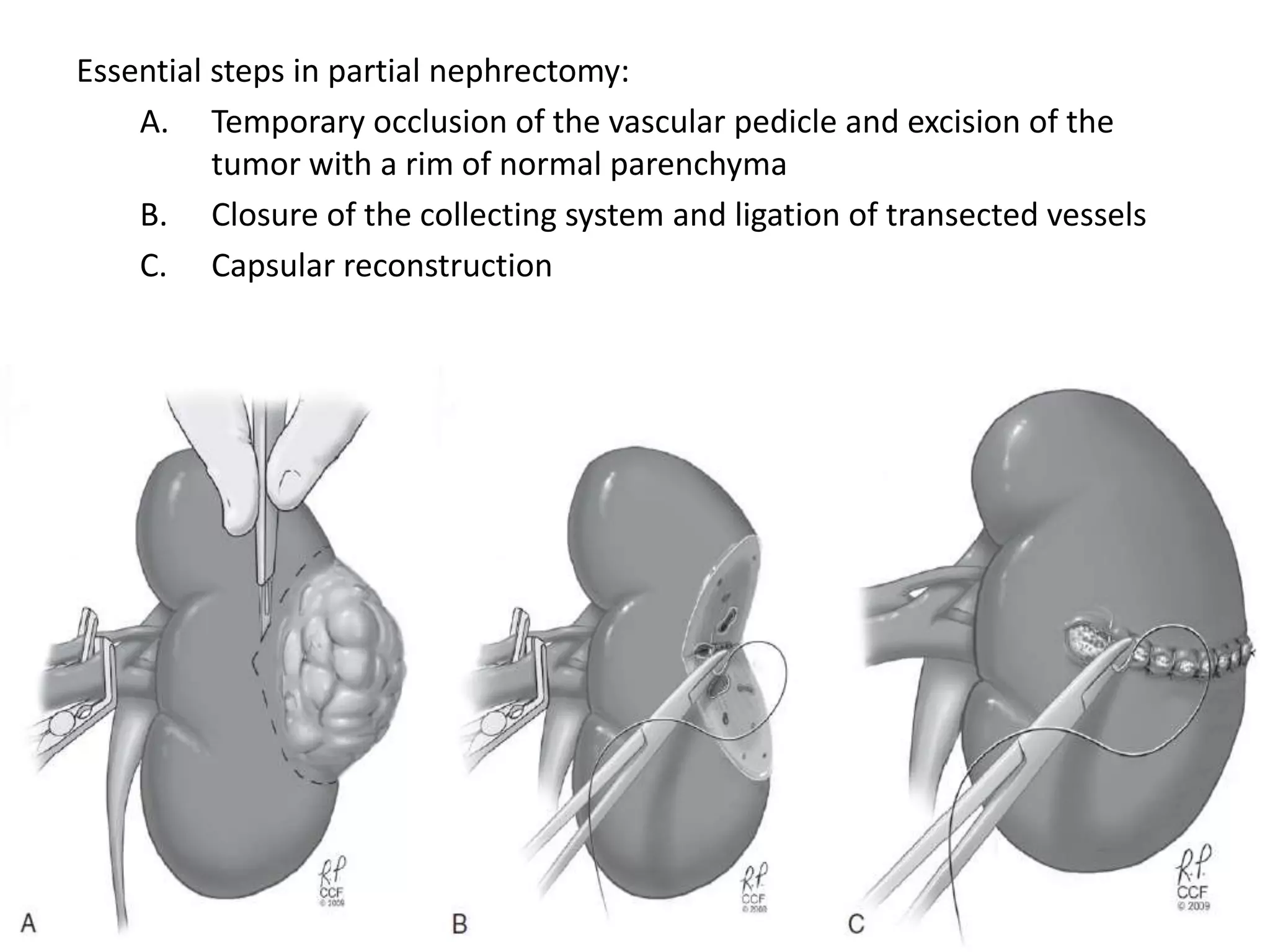 Renal cell carcinoma | PPTX