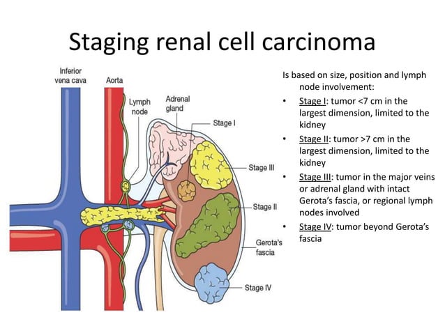 Renal cell carcinoma | PPT