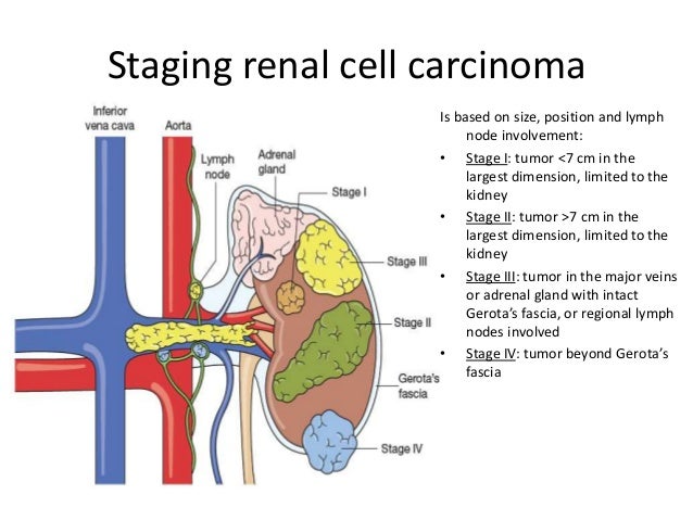Renal cell carcinoma