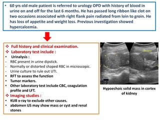 Renal cell carcinoma | PPT