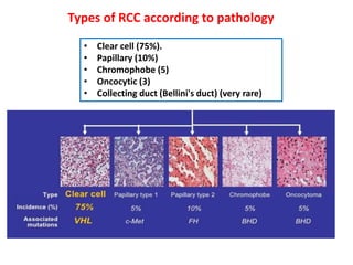 Renal cell carcinoma | PPT