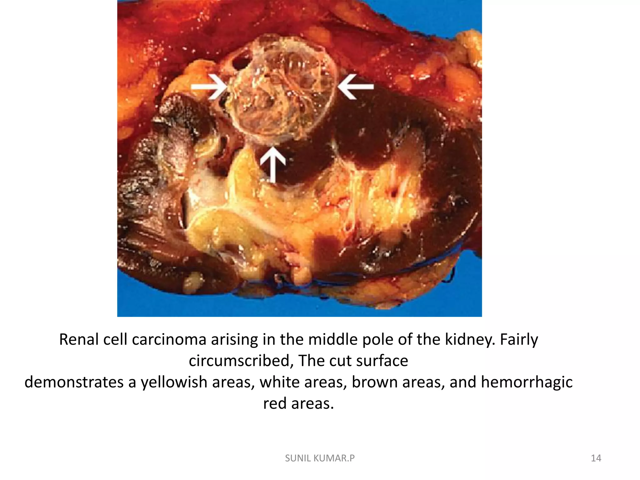 Renal cell carcinoma | PPT