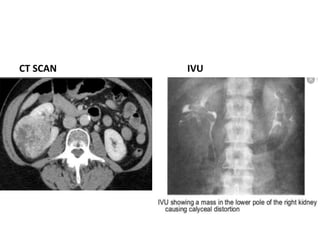 Renal cell carcinoma | PPT