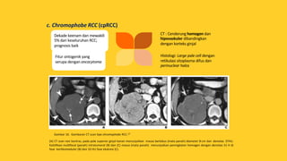 RENAL CELL CARCINOMA - ONCOCYTOMA.pdf