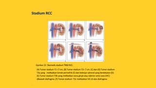 RENAL CELL CARCINOMA - ONCOCYTOMA.pdf