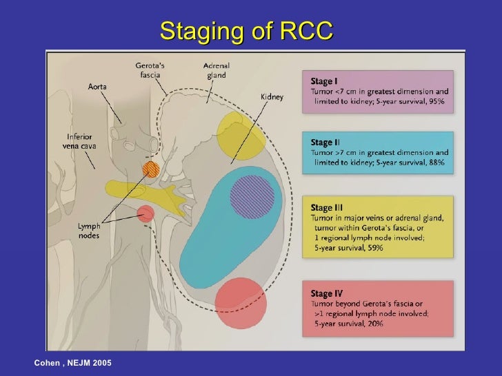 Renal Cell Carcinoma A New Standard Of Care