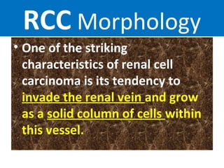 Renal cell carcinoma for students | PPT