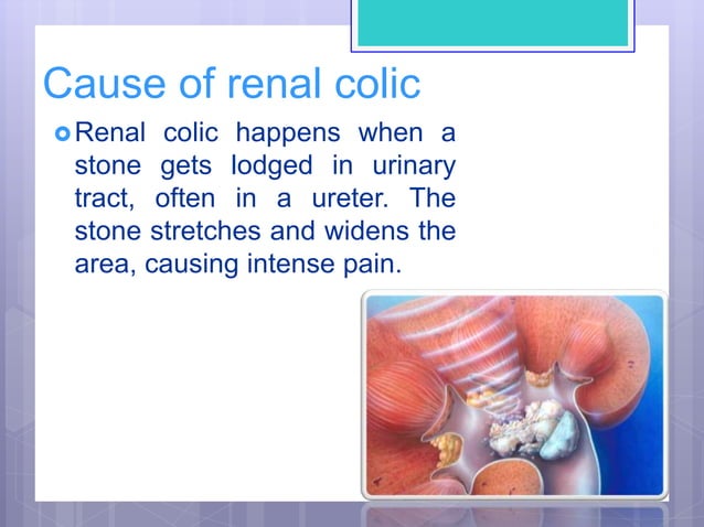 Renal colic | PPTX