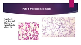 Renal complications in thalassemia | PPT