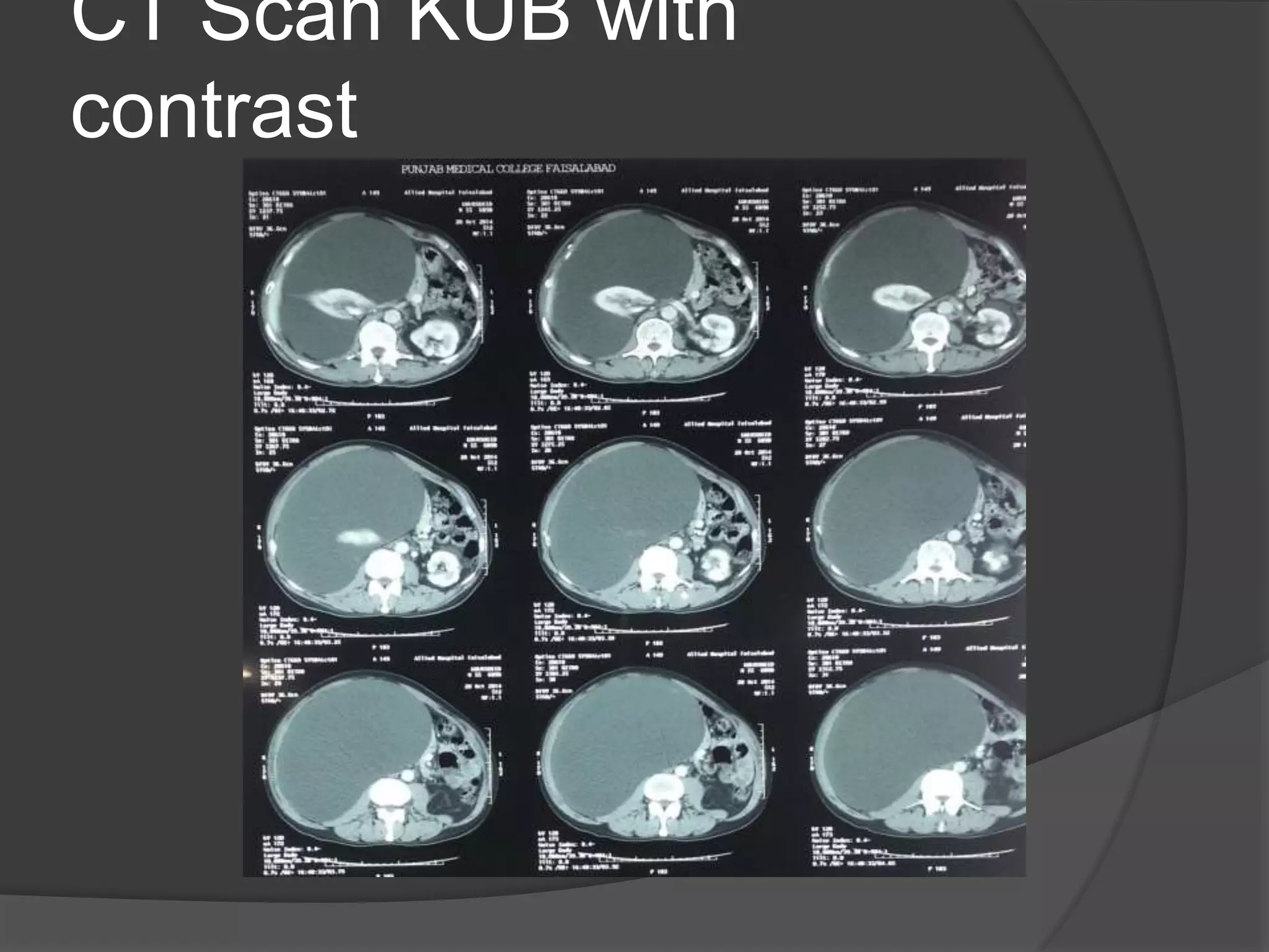 Renal cyst / Classification of Renal Cyst | PPTX