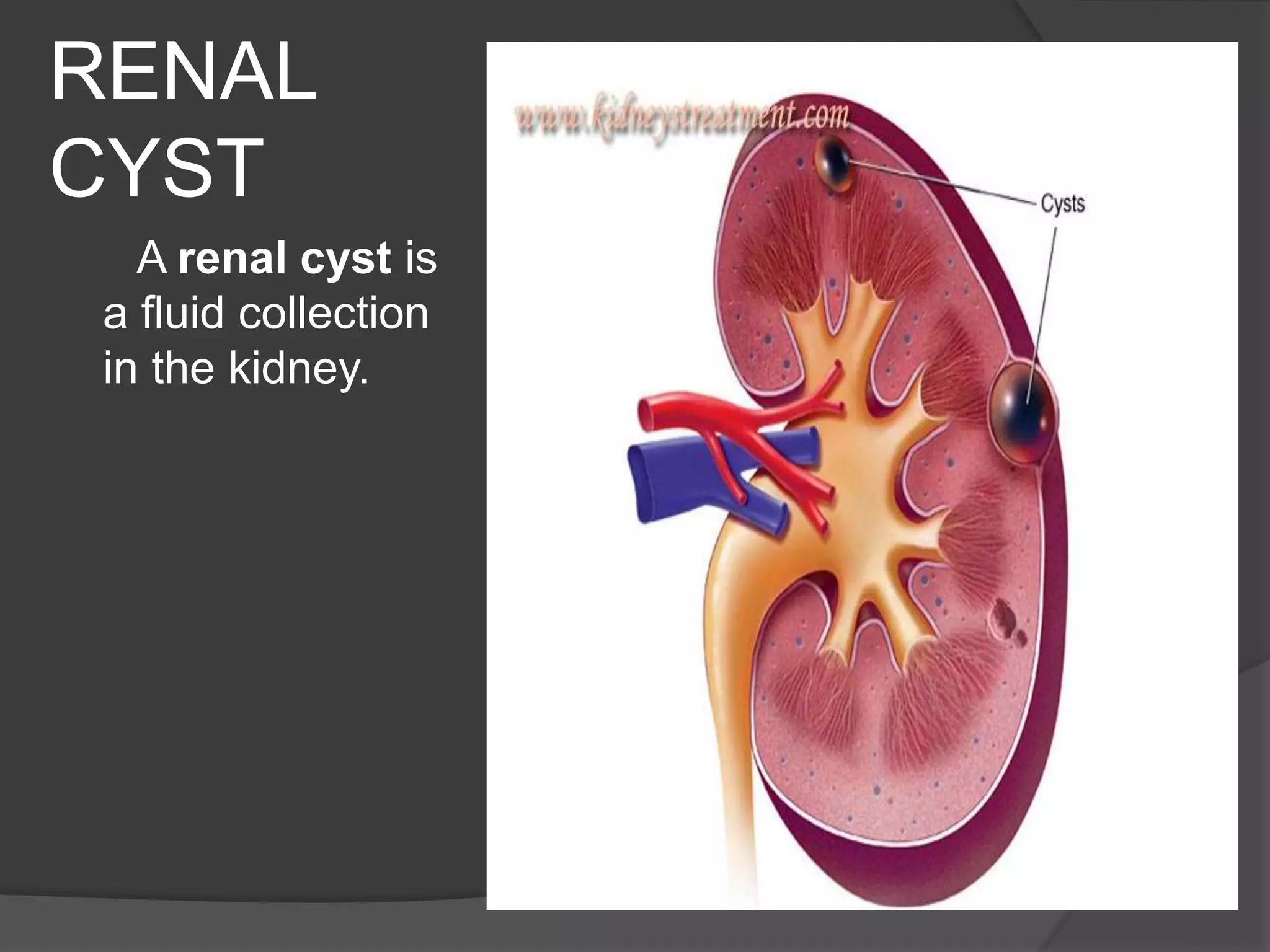 Renal cyst / Classification of Renal Cyst | PPTX