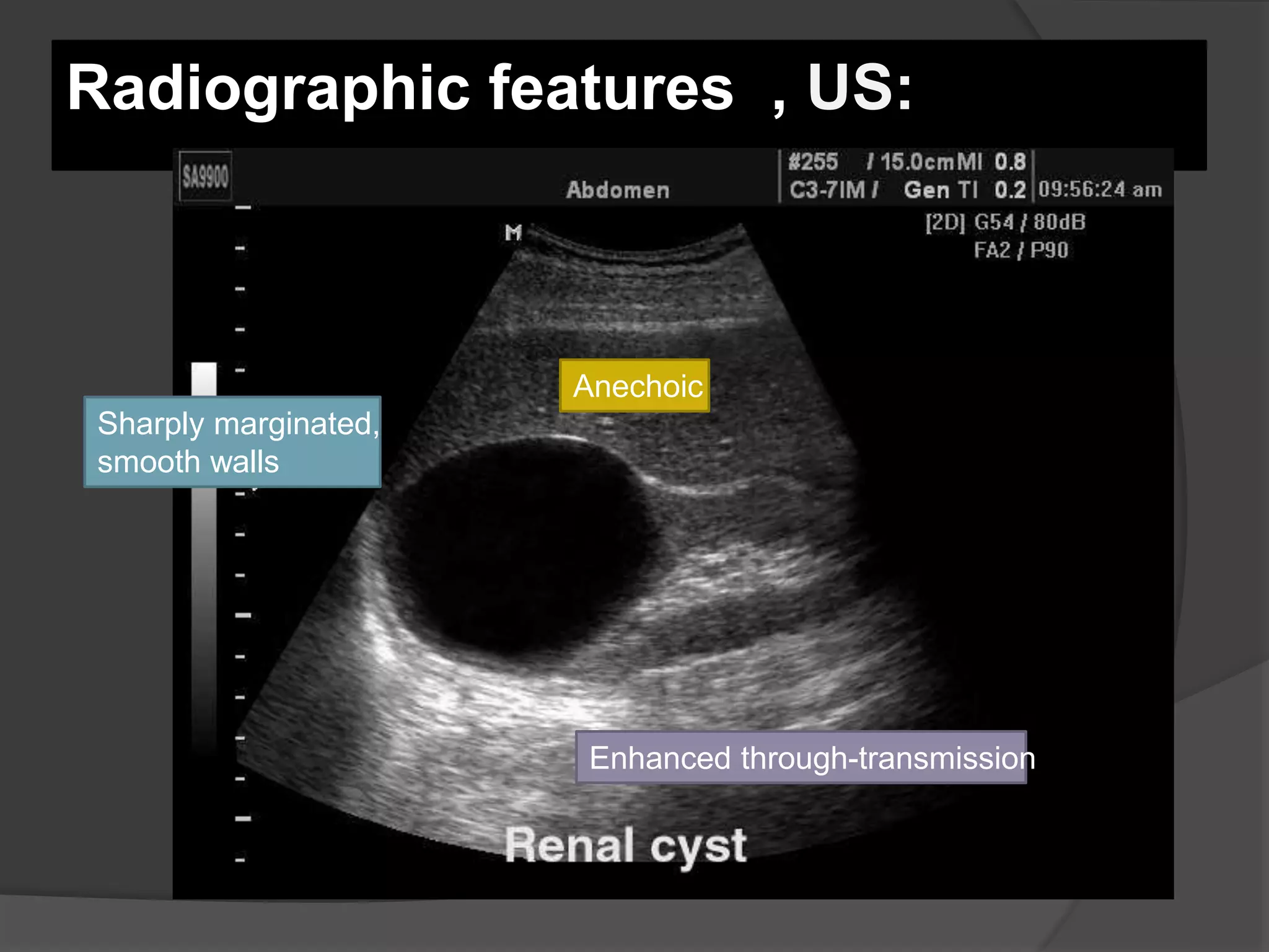 Renal cyst / Classification of Renal Cyst | PPTX