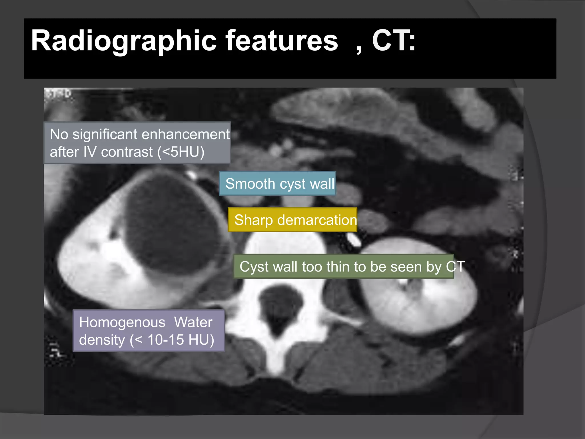 Renal cyst / Classification of Renal Cyst | PPTX