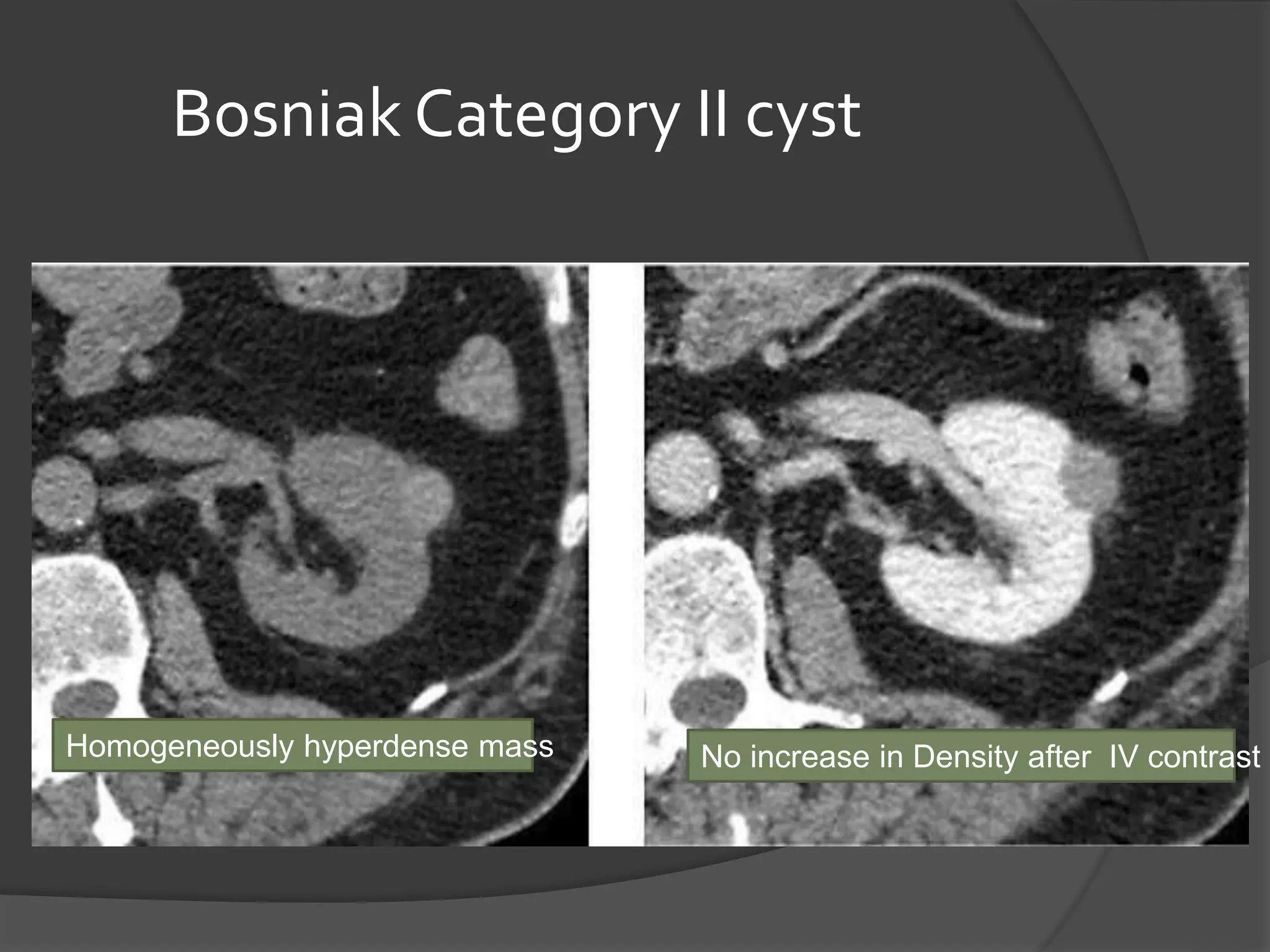 Renal cyst / Classification of Renal Cyst | PPTX