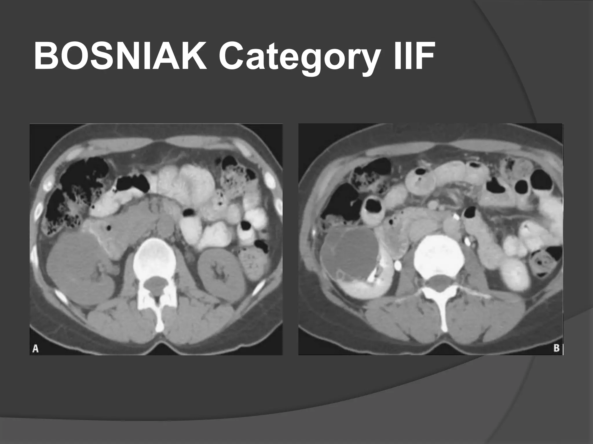 Renal cyst / Classification of Renal Cyst | PPTX