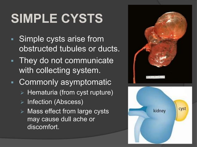 Renal cyst / Classification of Renal Cyst | PPTX