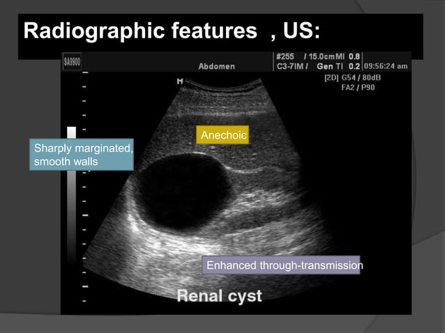 Renal cyst / Classification of Renal Cyst | PPTX