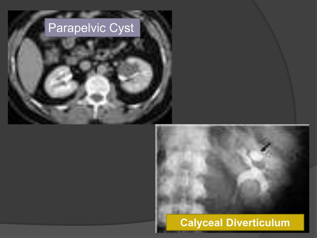 Renal cyst / Classification of Renal Cyst | PPTX