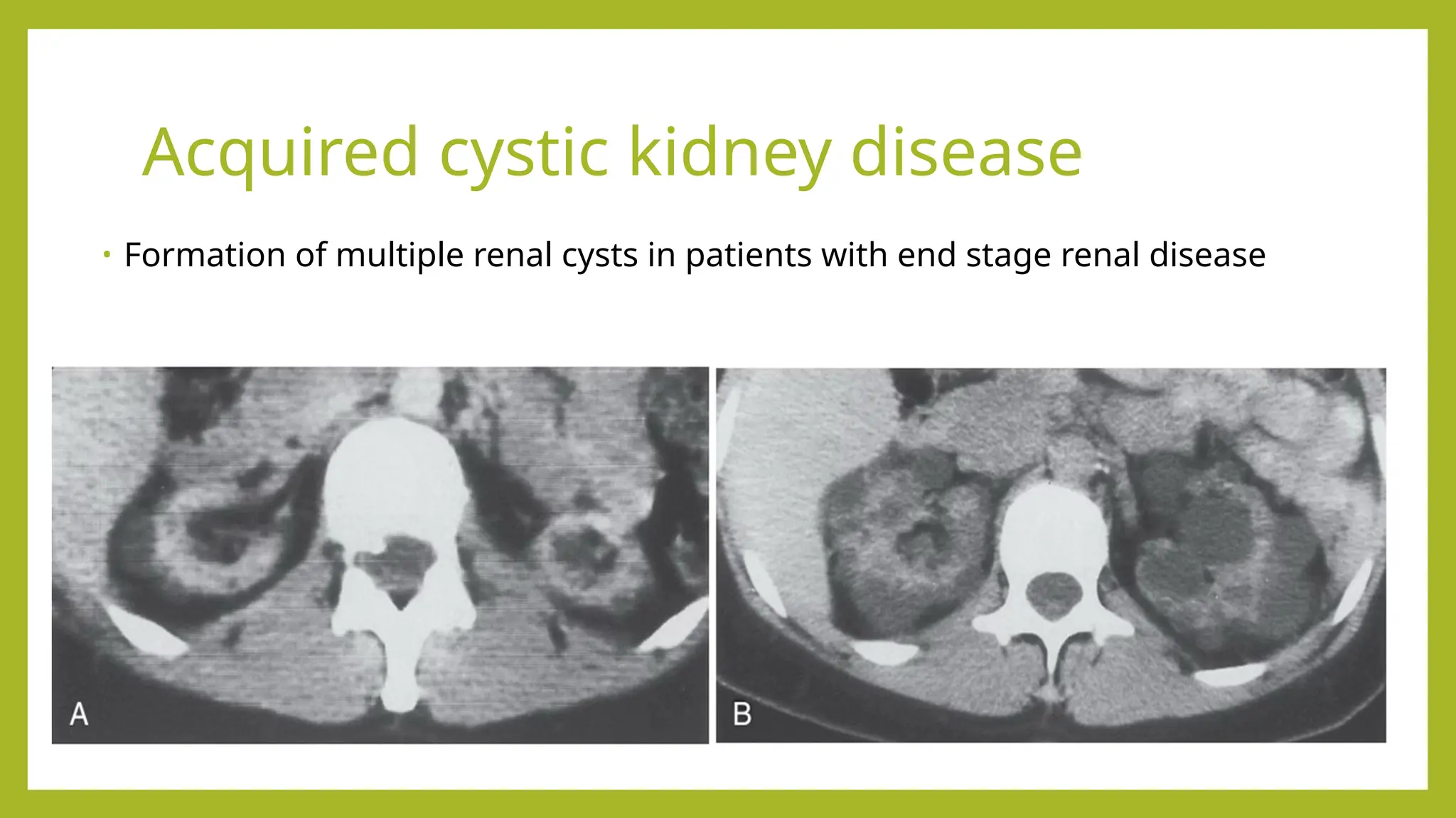 RADIOLOGICAL PRESENTATION OF RENAL CYSTIC DISEASE.pptx