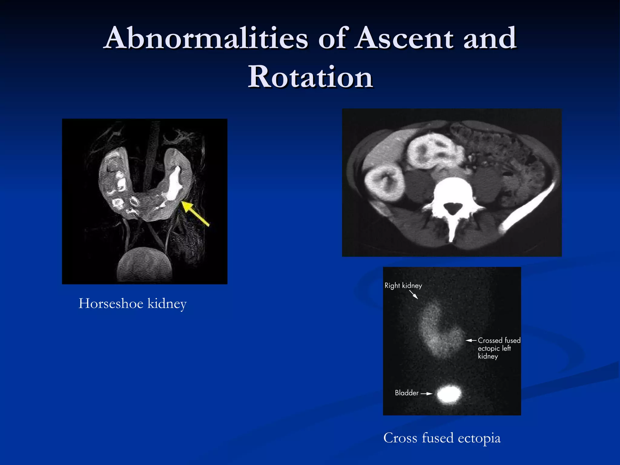 Renal Development Dysplasia 2 | PPT
