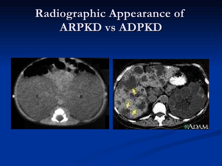 Renal Development Dysplasia 2