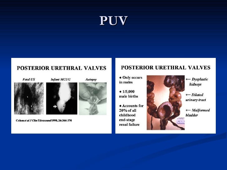 Renal Development Dysplasia 2