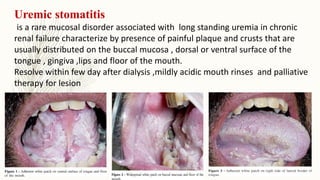 Uremic Stomatitis