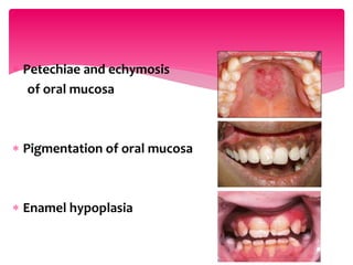 dental management of a renal disorder patient | PPTX