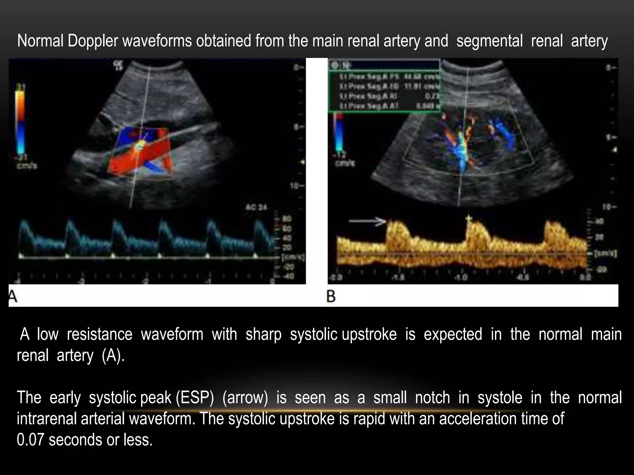 Renal doppler | PPTX