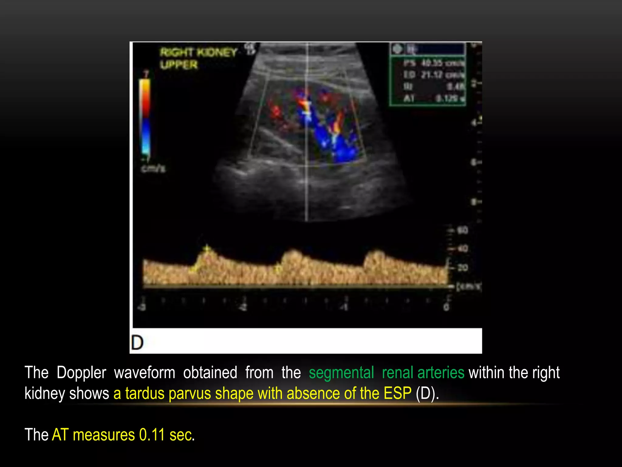 Renal doppler | PPTX