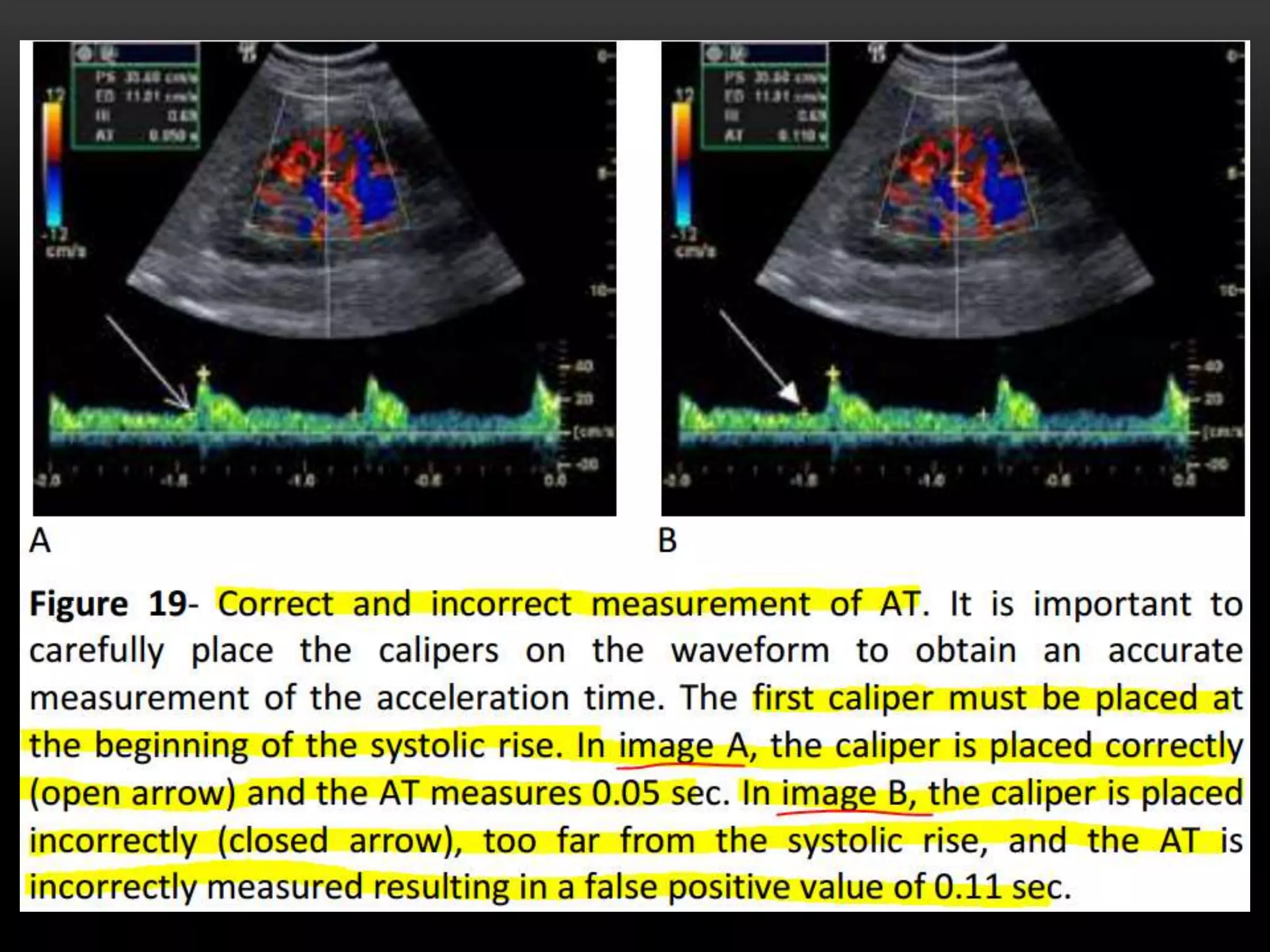 Renal doppler | PPTX