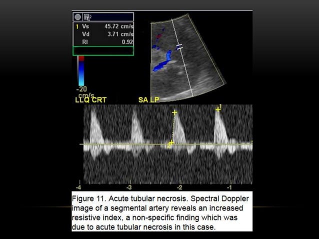 Renal doppler | PPTX | Heart and Cardiovascular Diseases | Diseases and ...