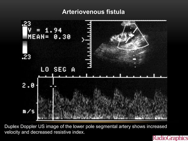 Renal doppler | PPTX | Heart and Cardiovascular Diseases | Diseases and ...