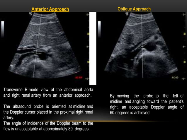 Renal doppler | PPTX | Heart and Cardiovascular Diseases | Diseases and ...