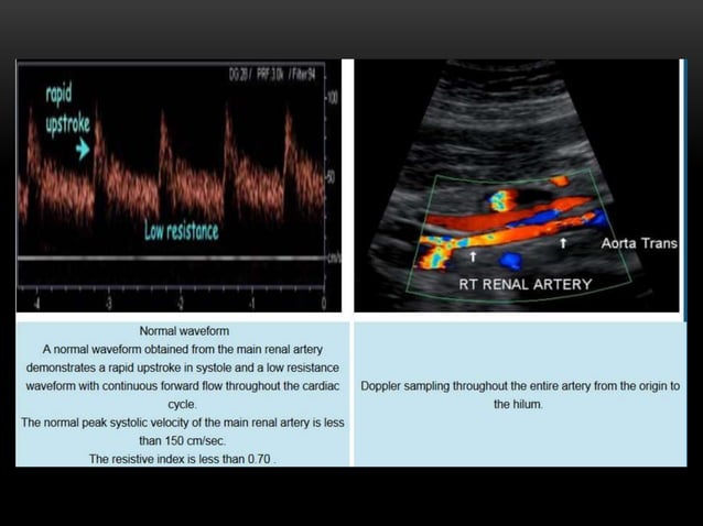 Renal doppler | PPTX | Heart and Cardiovascular Diseases | Diseases and ...