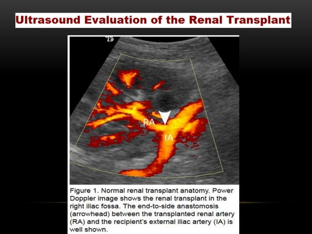 Renal doppler