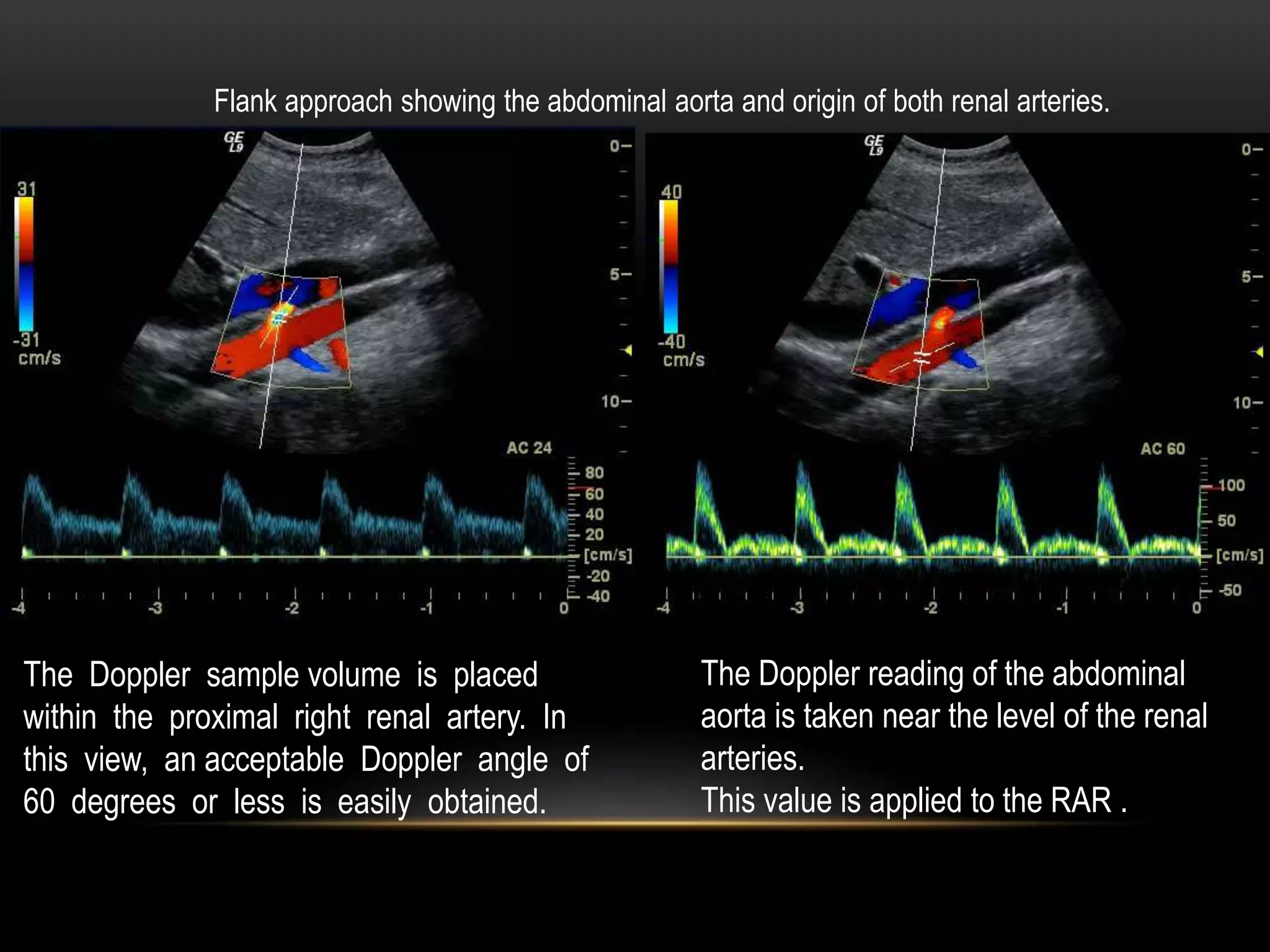 Renal doppler usg | PPTX