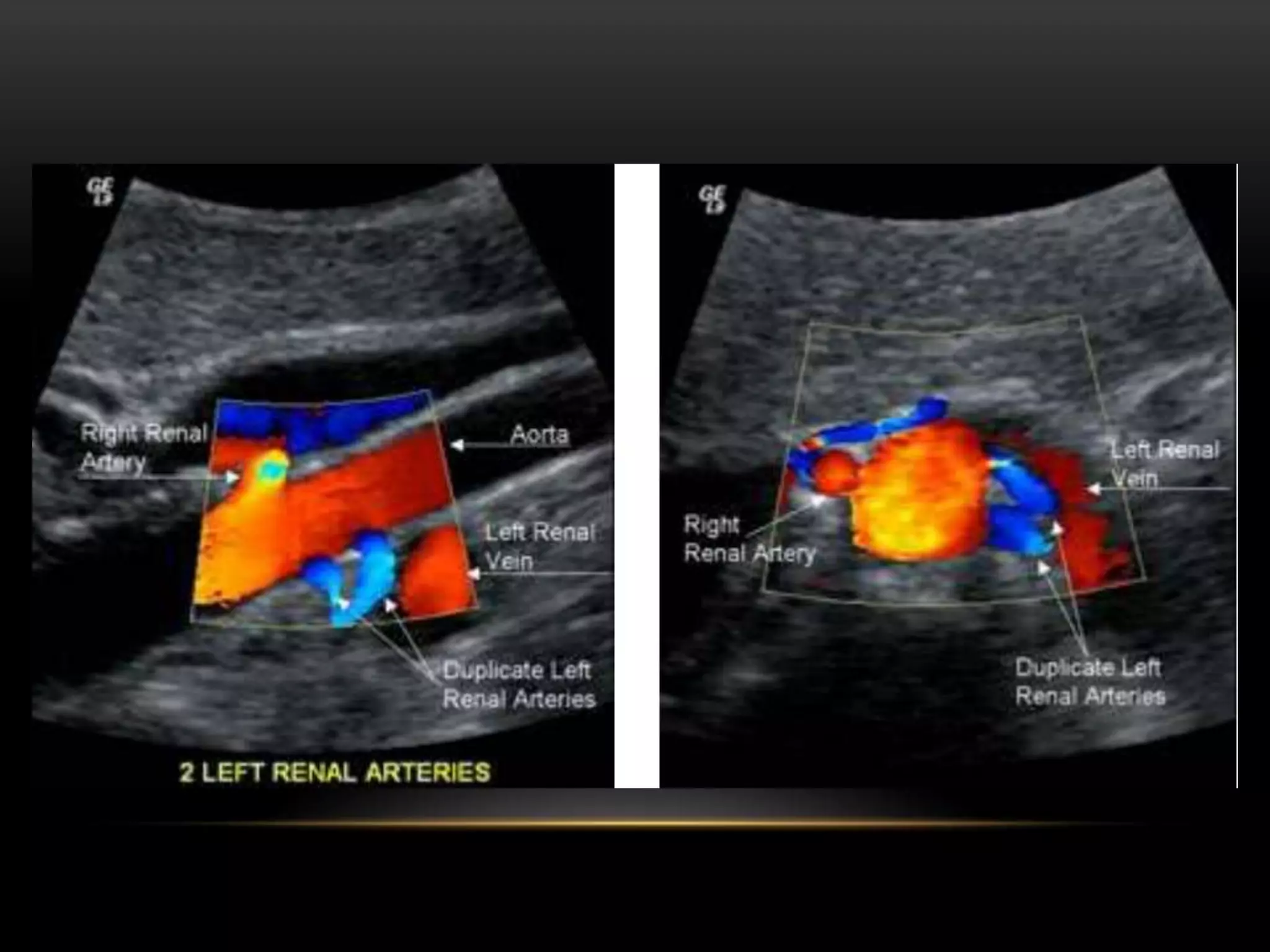 Renal doppler usg | PPTX