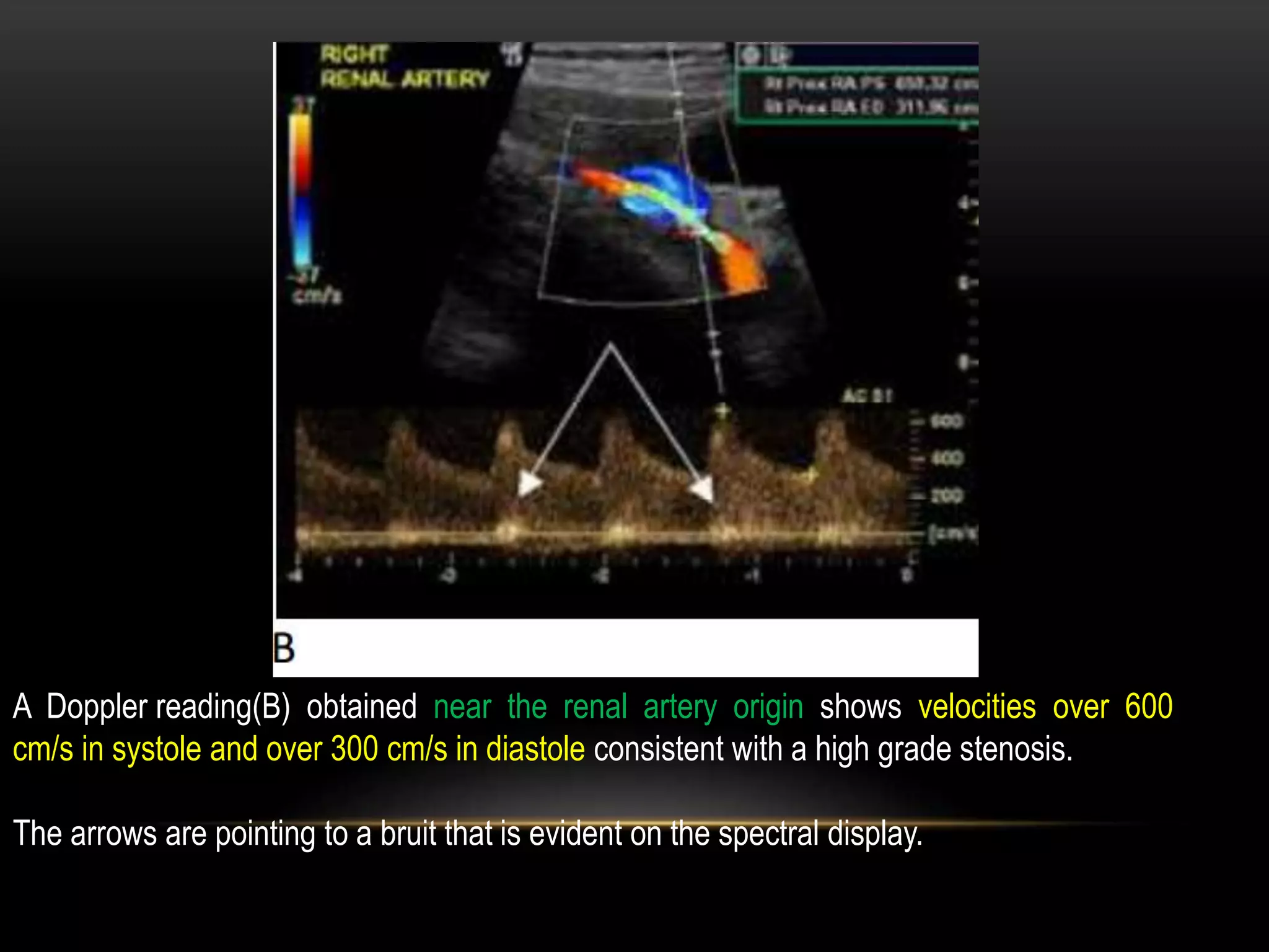 Renal doppler usg | PPTX