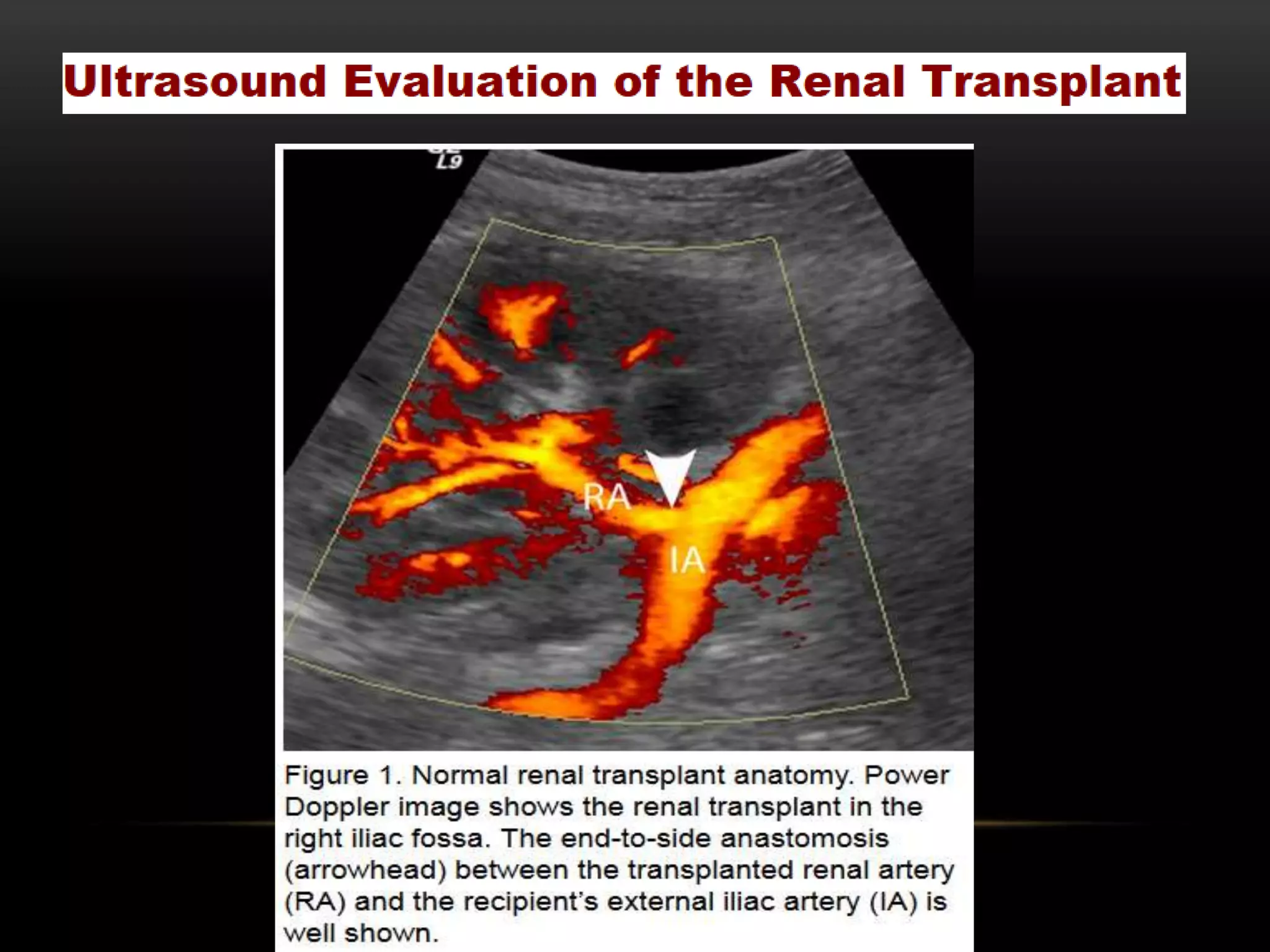 Renal doppler usg | PPTX