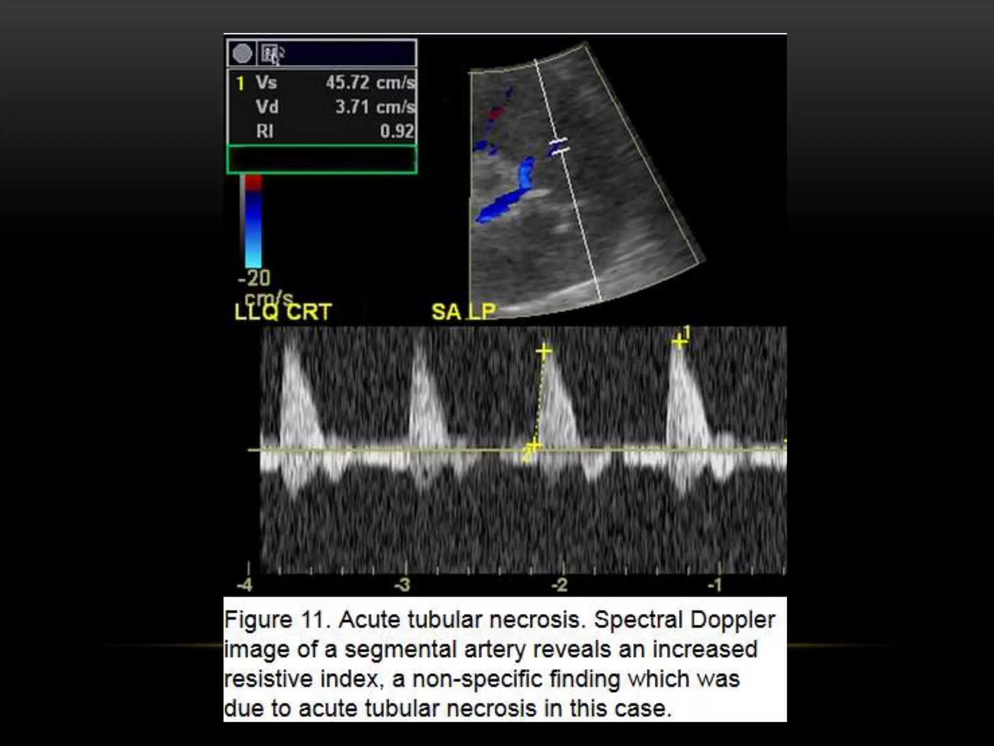 Renal doppler usg | PPTX