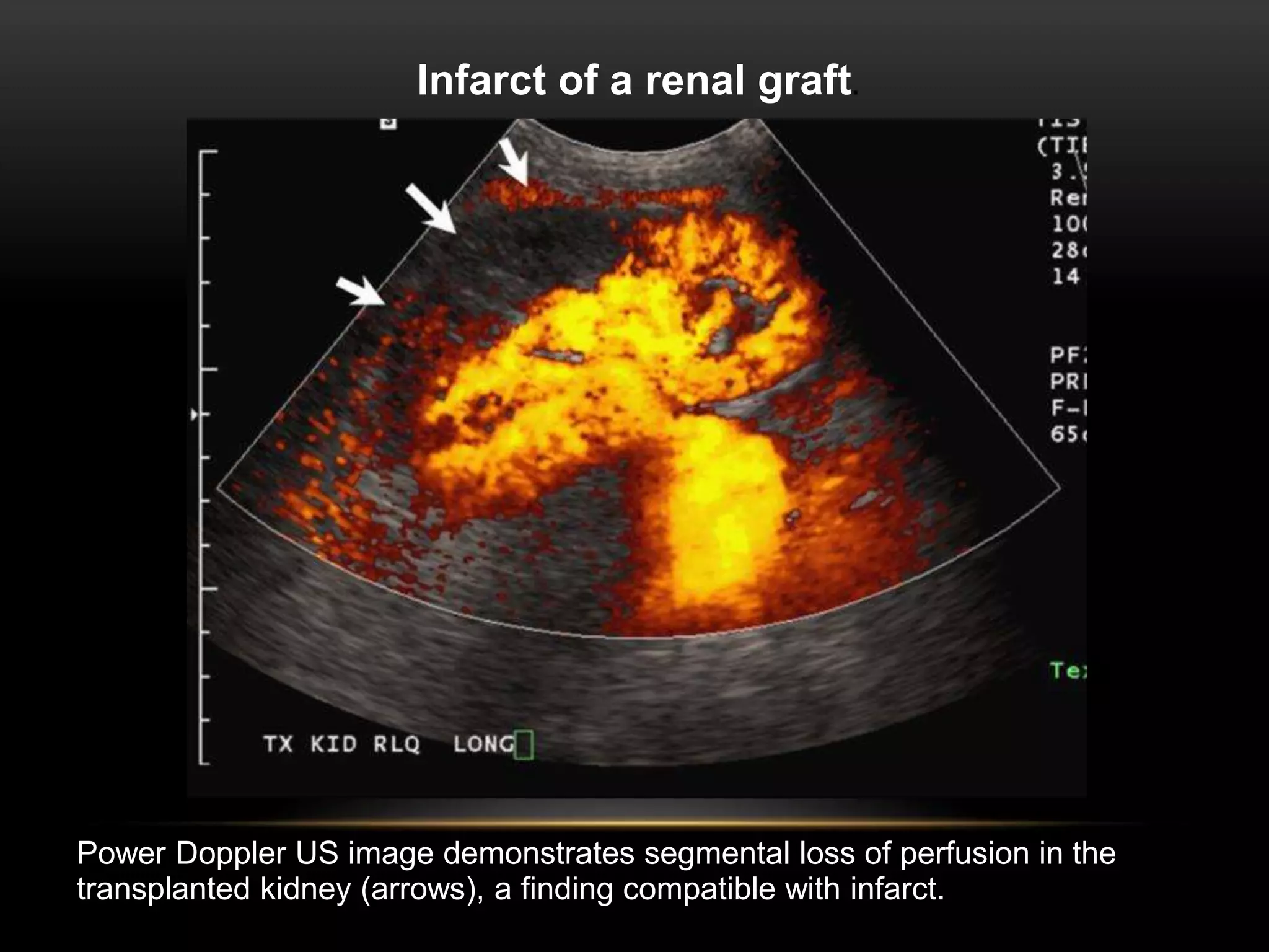 Renal doppler usg | PPTX